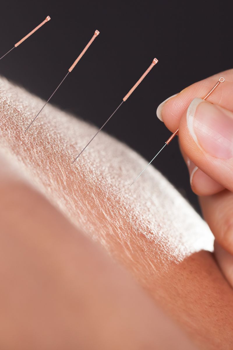 Acupuncture Treatment in Sherwood Park, AB | All Deep Massage & Wellness